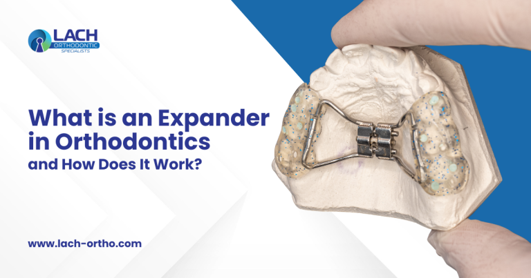 #1 Best Expander in Orthodontics – Know Benefits & Treatment